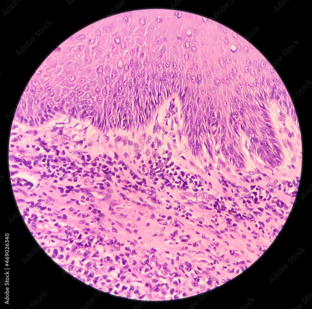 Microscopic image of malignant melanoma in pigmented ulcer. show ...