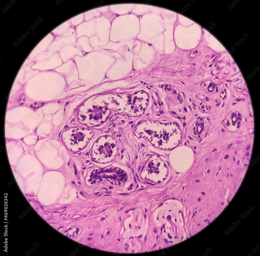 Microscopic image of malignant melanoma in pigmented ulcer. show ...