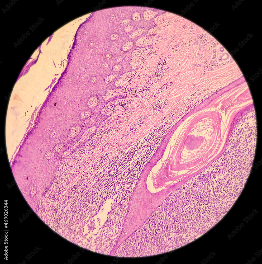 Microscopic image of malignant melanoma in pigmented ulcer. show ...