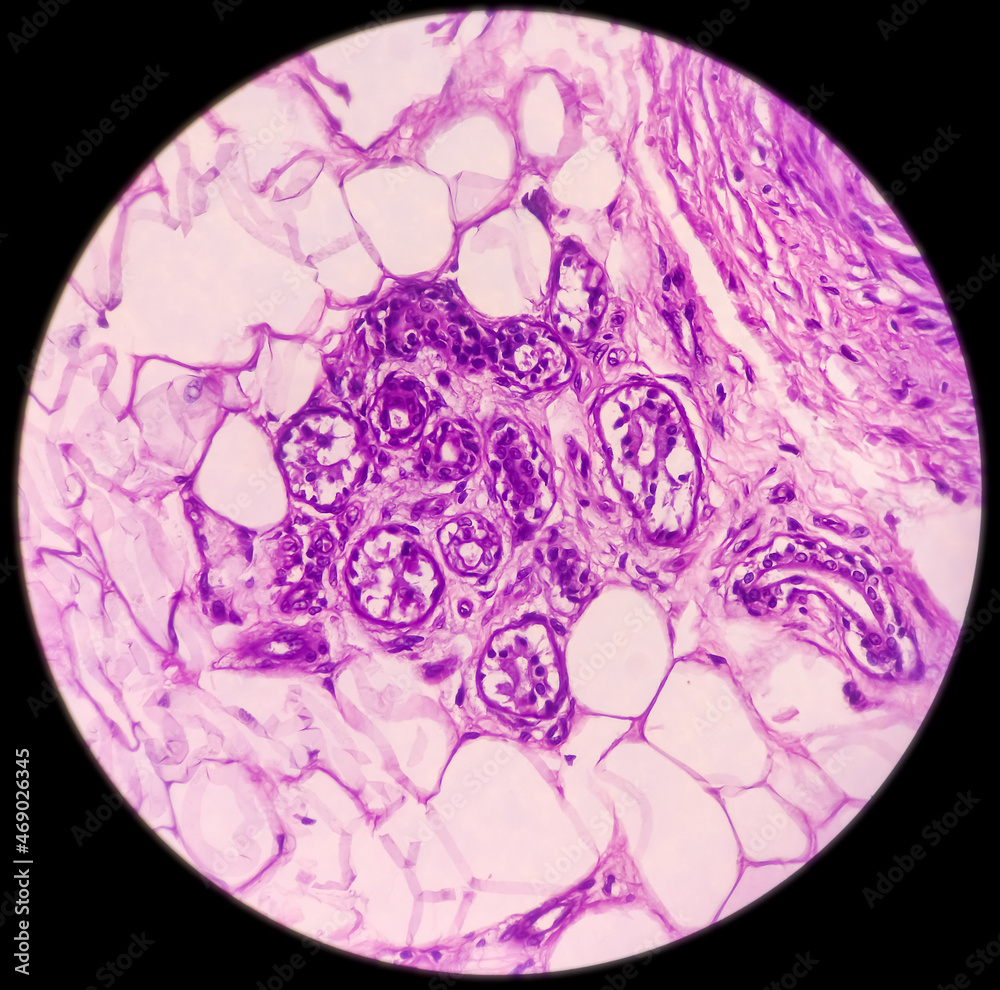 Microscopic image of malignant melanoma in pigmented ulcer. show ...