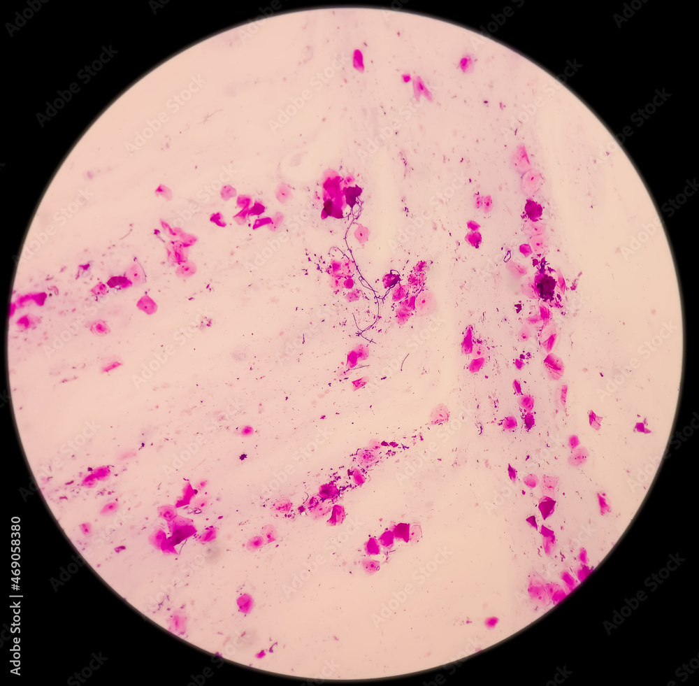 Gram Stain Gram Positive Cocci Gram Positive Diplococci Bacteria Candida Present Squamous