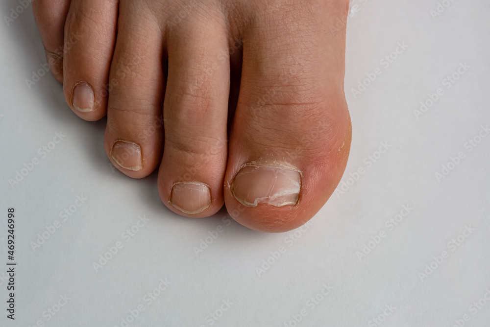 Broken toenail on white background. Stock Photo | Adobe Stock