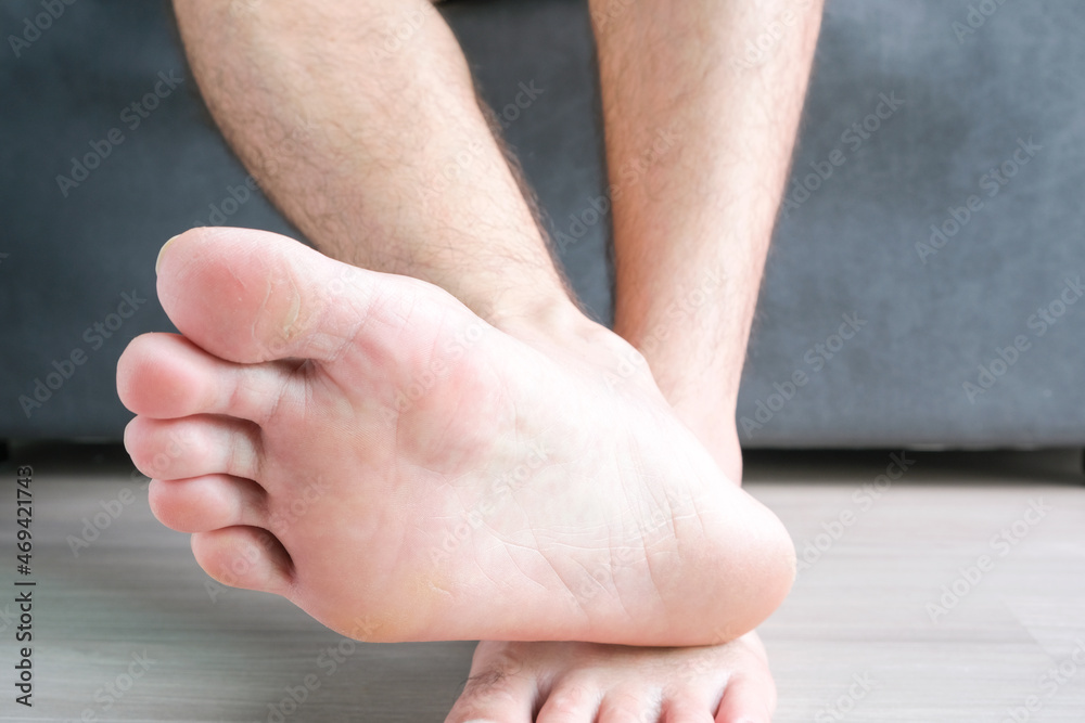 Cracked, dry and peeling skin on the toes from a fungal infection. of ...