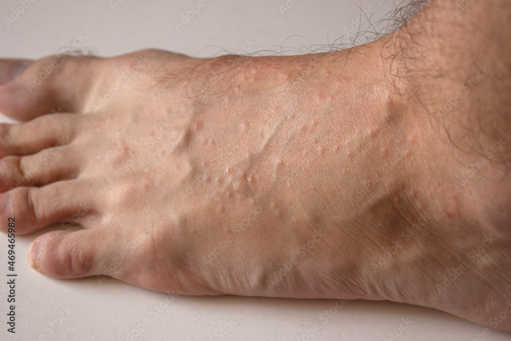 Allergic reaction on the leg. Rash on the foot. Dermatological disease ...