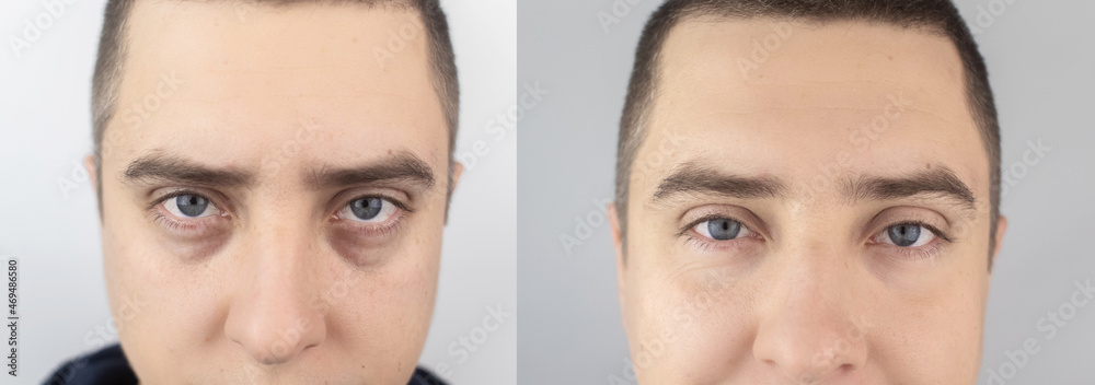 Before and after. Bags under eyes, hernias on the man face. Patient ...