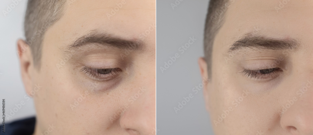 Before and after. Bags under eyes, hernias on the man face. Patient ...