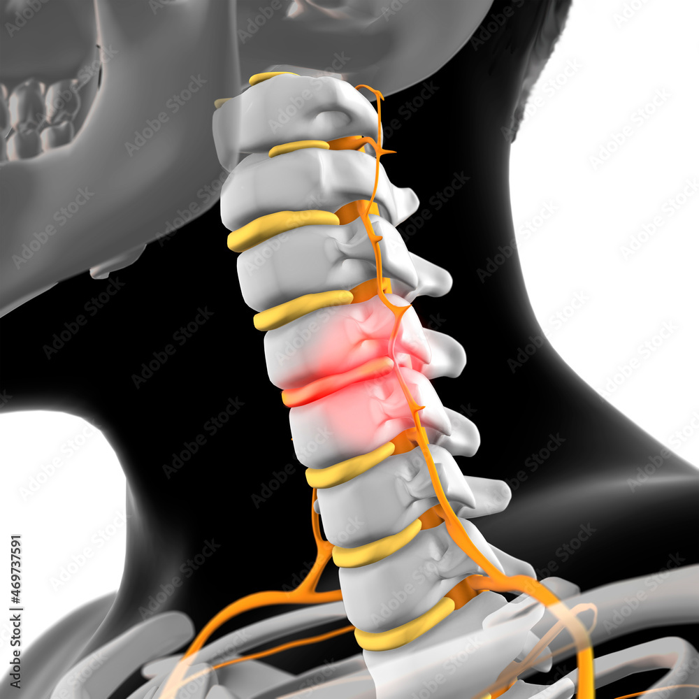 Neck Cervical Herniation