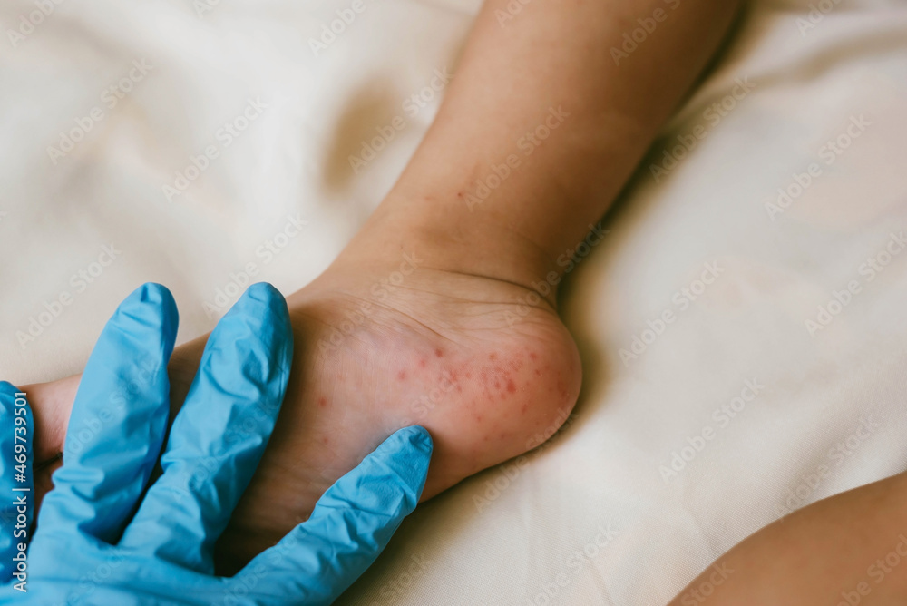 Rash of enterovirus infection picornavirus families on the feet of a 3 ...