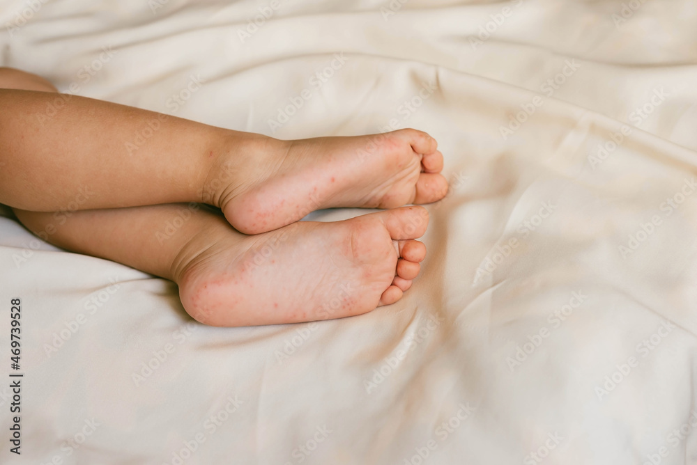 Rash of enterovirus infection picornavirus families on the feet of a 3 ...