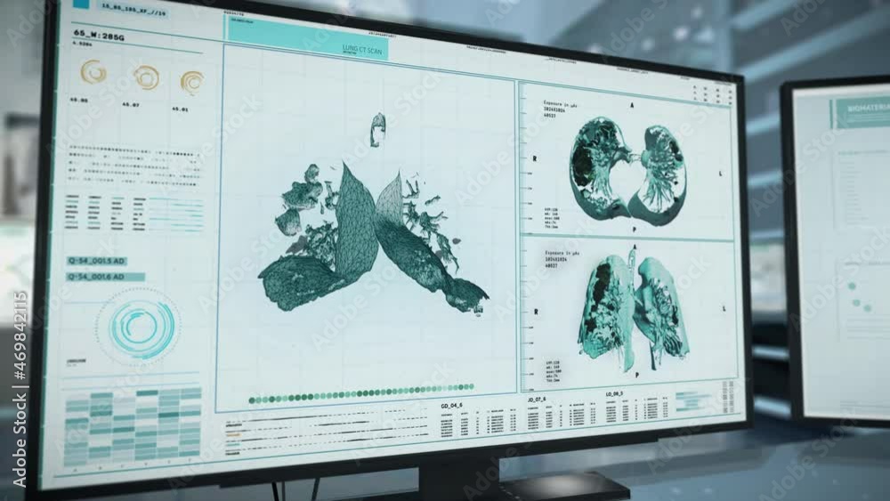 Lung Cancer Disease Mri Scan In Biology Science Laboratory. Patients ...