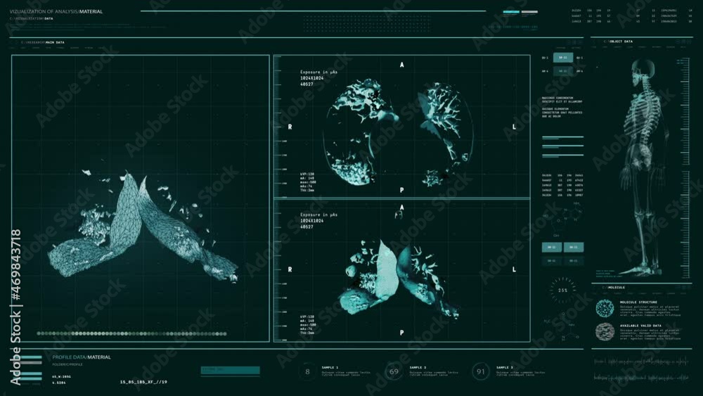 Medical Diagnostic Computer Scanning Lungs Diagnoses Covid-19 Pneumonia ...