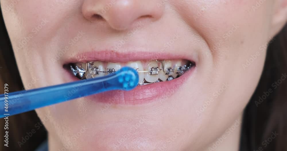 Woman brushing braces with monobunched toothbrush, close-up. Cropped ...