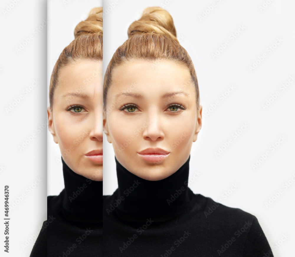 Effects of ageing,Frown/scowl lines ,Nasolabial folds,Neck ,Under eye ...