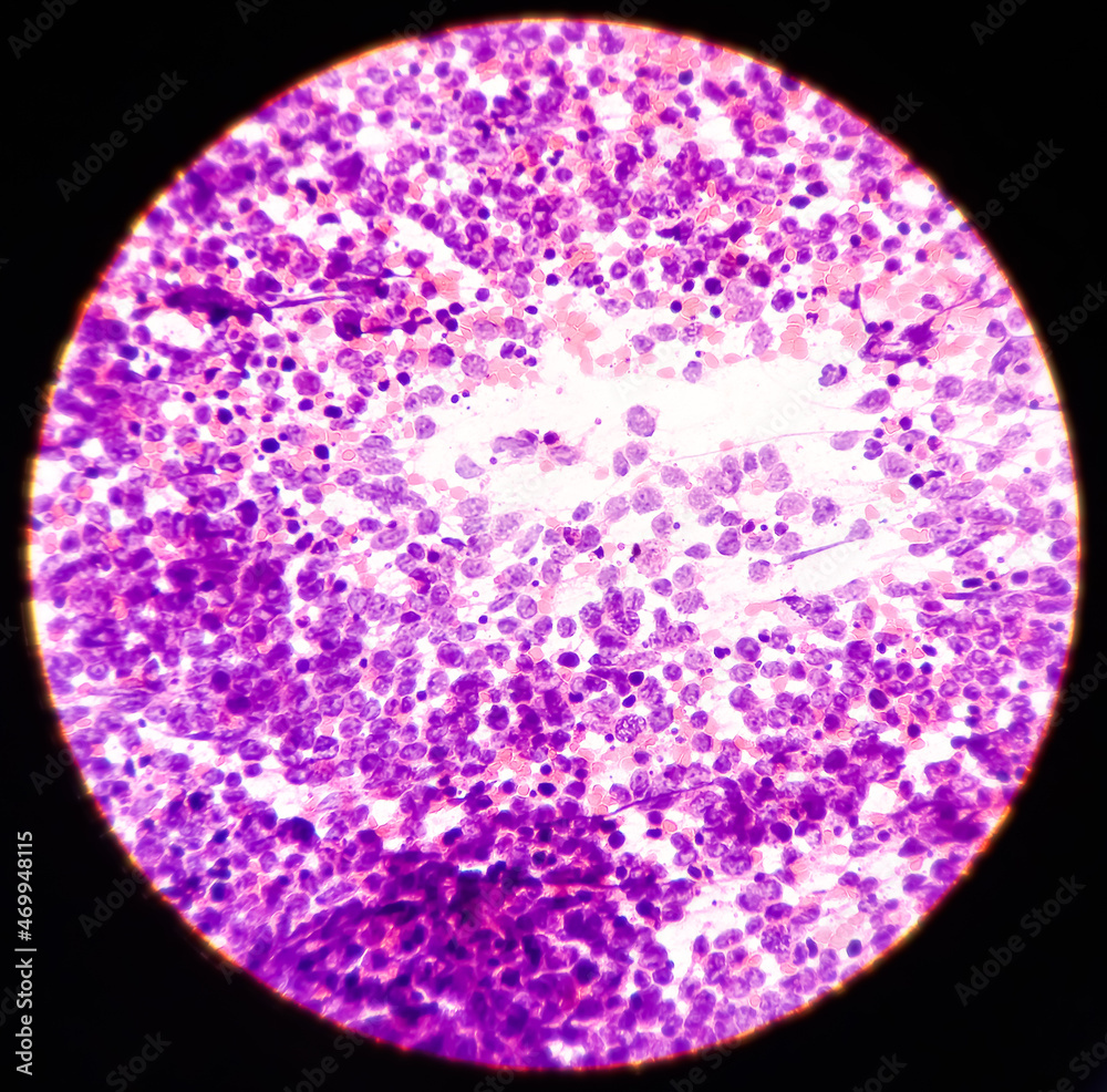 Kidney cancer: Specimen collected by CT guided FNA from renal mass ...
