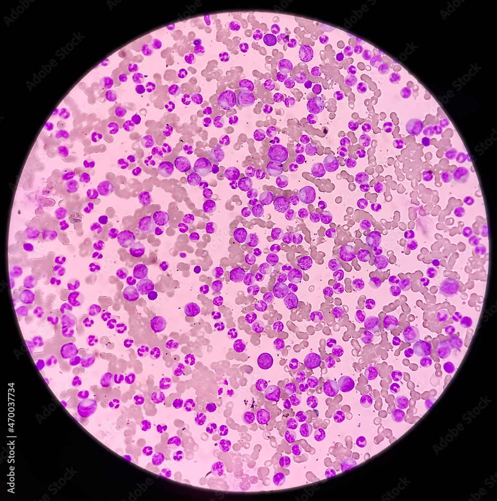 Blood cancer. Chronic myelogenous leukemia, also known as Chronic ...