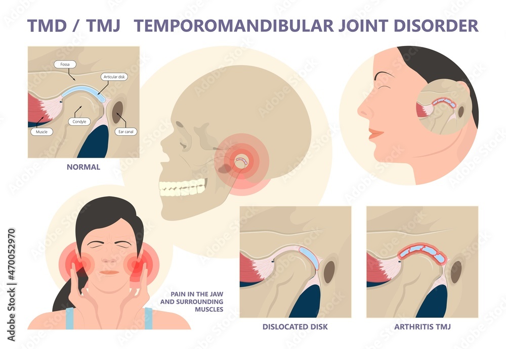 Temporomandibular Joint Disorders TMD TMJ treat pain displaced disc ...