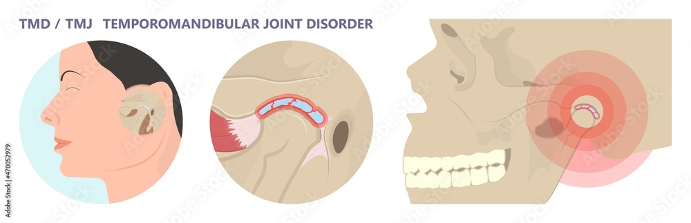Fotografía Temporomandibular Joint Disorders TMD TMJ treat pain displaced disc temporal bon ...