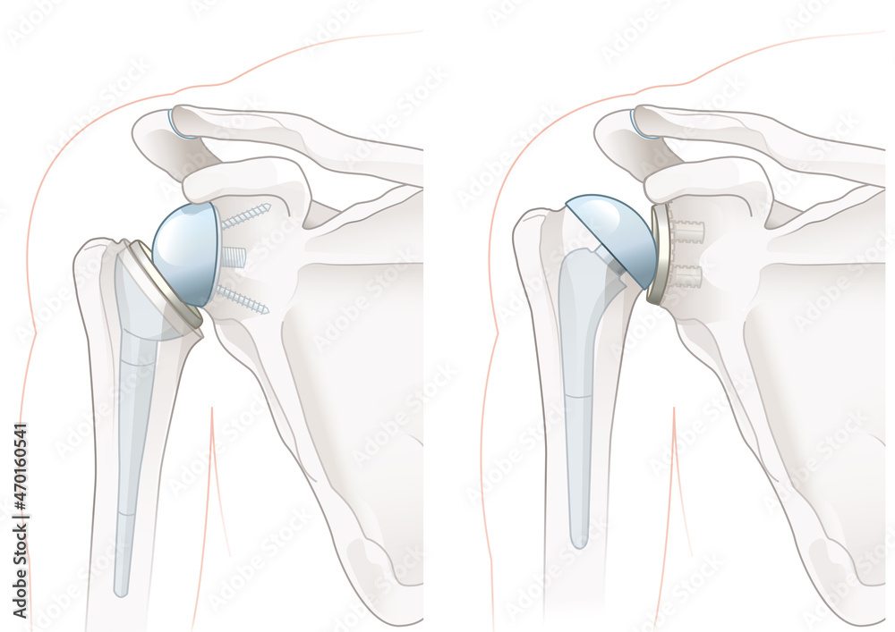 Shoulder arthroplasty. Shoulder replacement. Illustration Stock ...