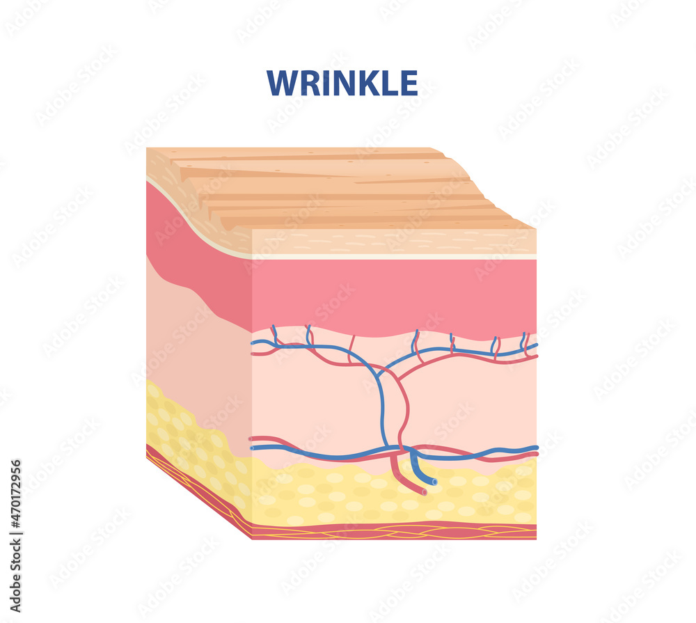 Skin Type Sticker. Age related dermis with wrinkles. Layers of skin ...