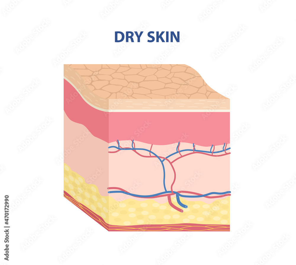 Skin Type Sticker. Dry skin. Layers with cracked dermis from lack of ...