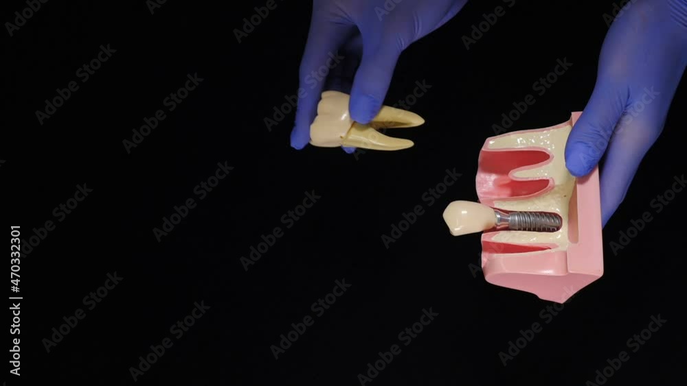 Tooth extraction concept. Dentistry and teeth care concept. Dental ...