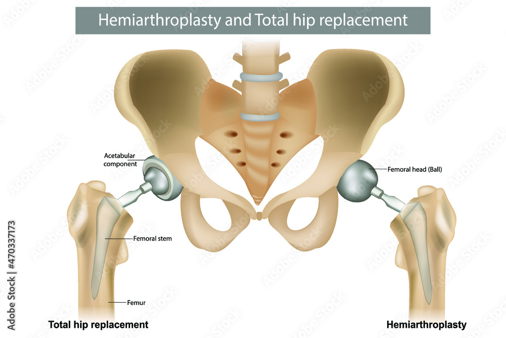 Total hip replacement components and Hemiarthroplasty. Hip Implant ...