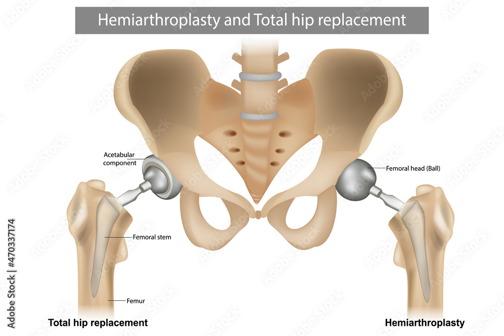 Total Hip Replacement Components And Hemiarthroplasty Implant Stock
