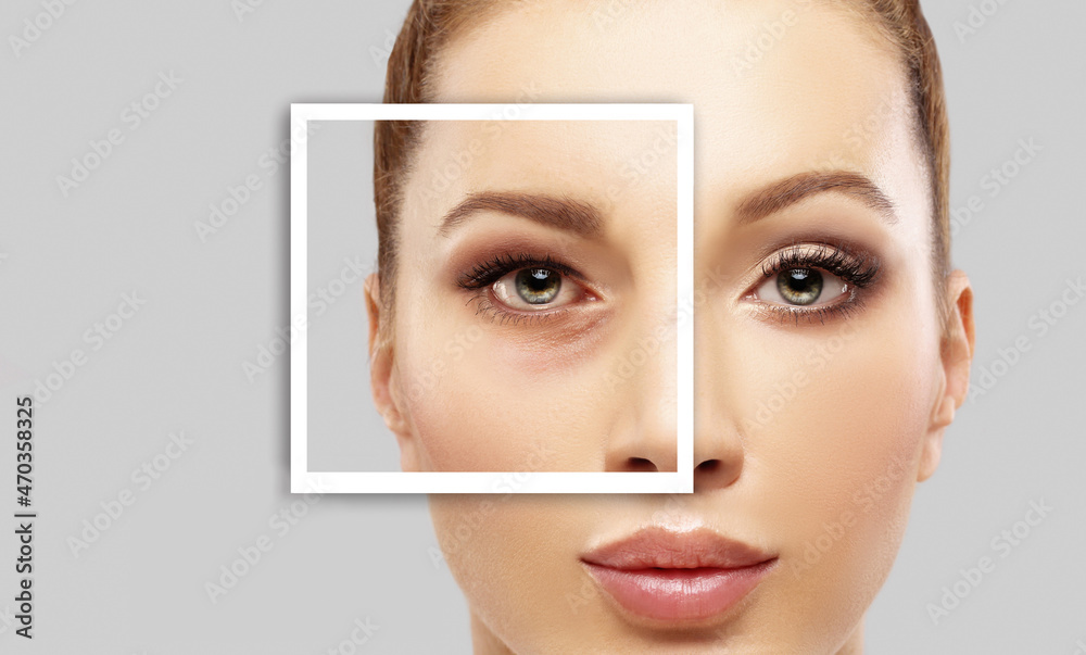 Lower and upper Blepharoplasty.Marking the face.Perforation lines on ...