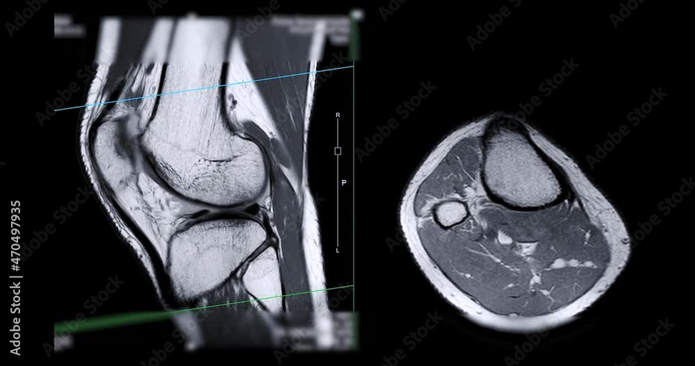 MRI knee or Magnetic resonance imaging of knee joint for detect acl ...