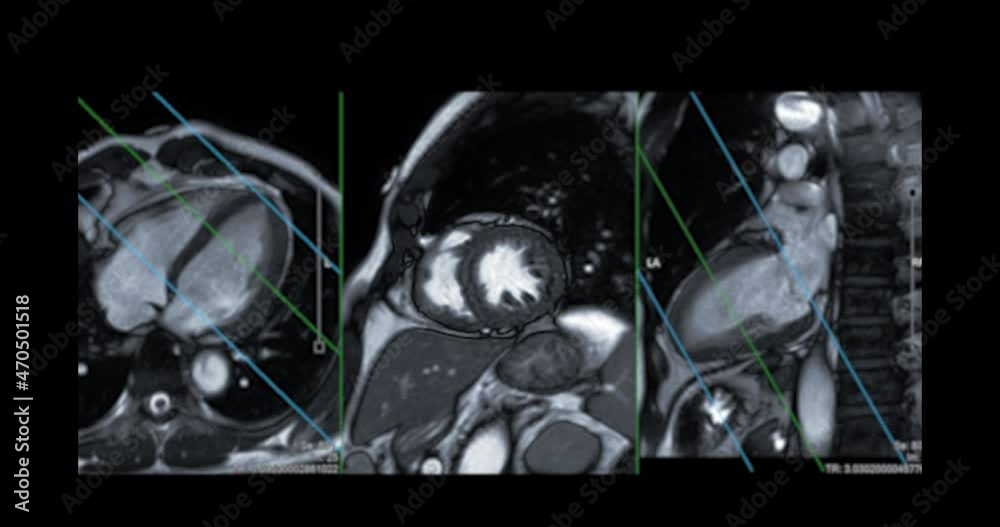 MRI heart or Cardiac MRI ( magnetic resonance imaging ) of heart ...