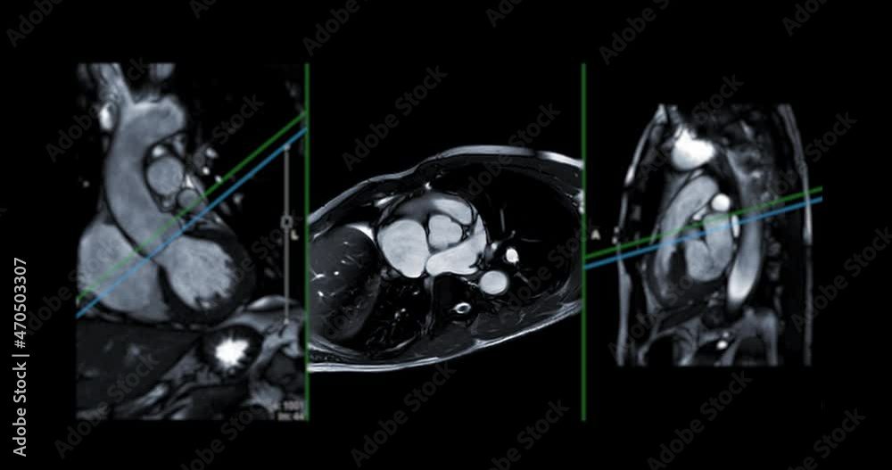 MRI heart or Cardiac MRI ( magnetic resonance imaging ) of heart ...