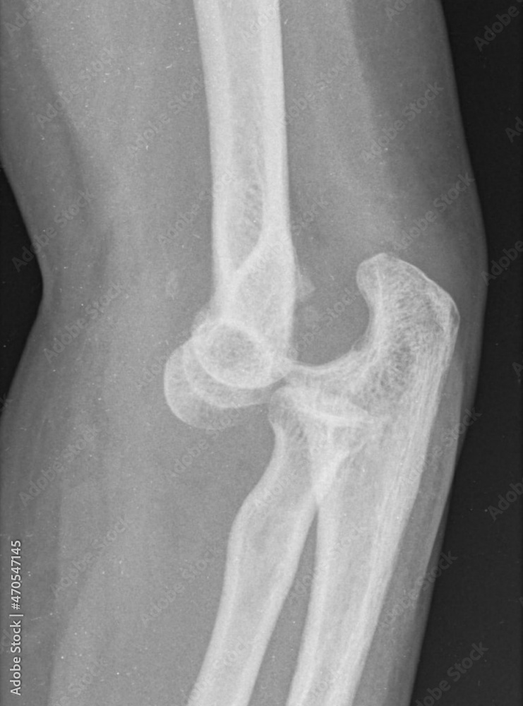x ray of a elbow dislocation,broken elbow Stock Photo | Adobe Stock