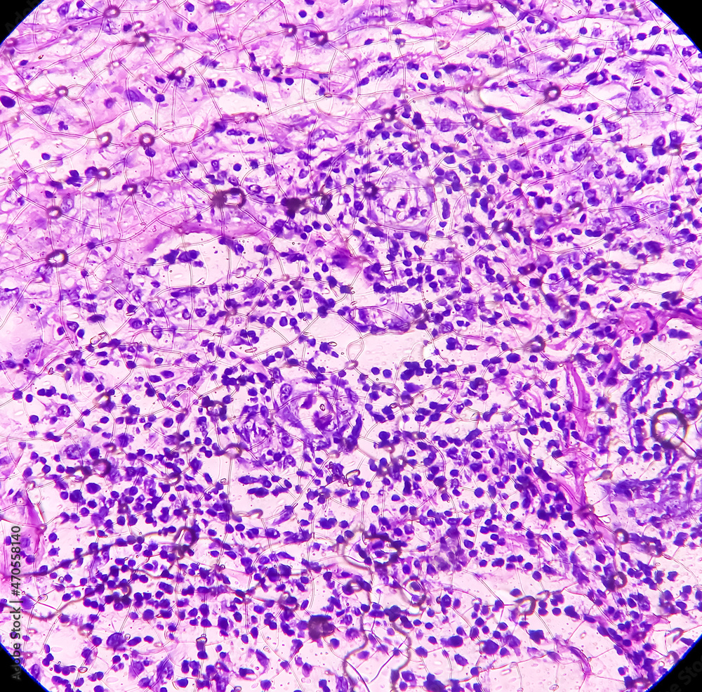 Pilonidal disease, pilonidal sinus tract, microphotograph of Compatible ...