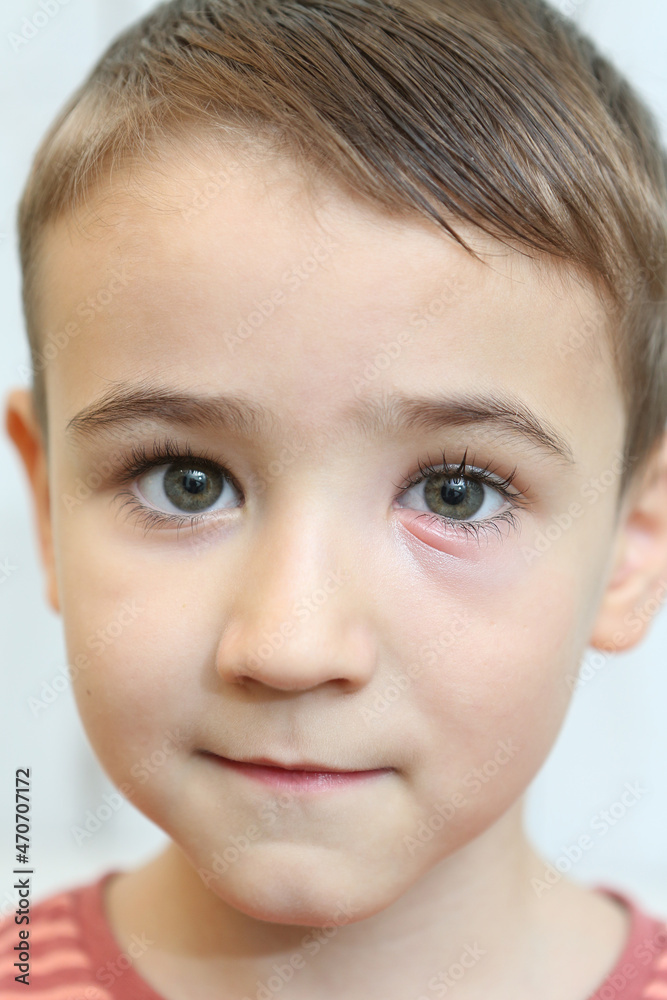 Stye, hordeolum, bacterial infection of oil gland in eyelid. Red tender ...