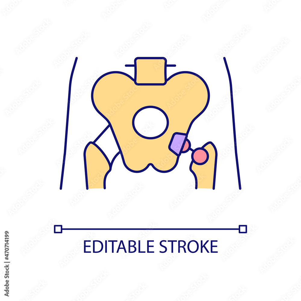 Hip replacement RGB color icon. Artificial prothesis. Metal joint implant. Surgical treatment ...