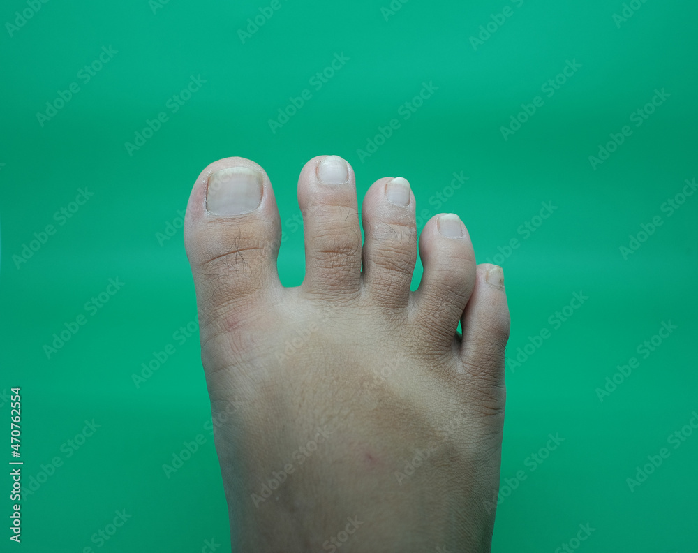 The tip of the right toe with long nails, and the surface of the foot ...
