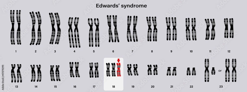 Human karyotype of Edwards' syndrome. Autosomal abnormalities. Trisomy ...