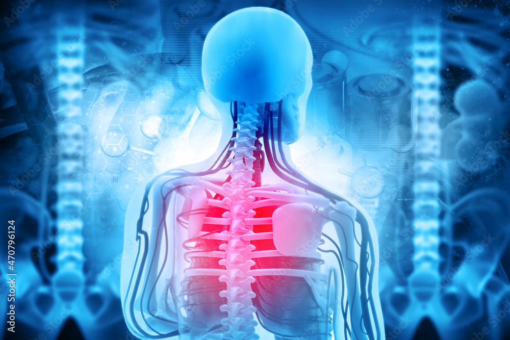 Spine cancer or spinal tumor disease Stock Illustration | Adobe Stock