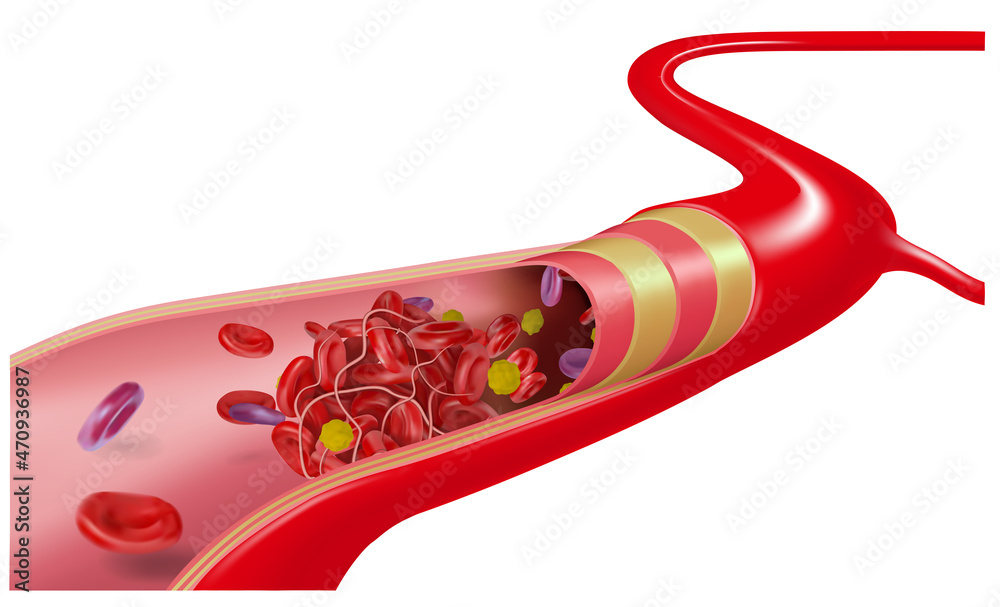 Diagram of the structure of a vein and blood with a thrombus on a white ...