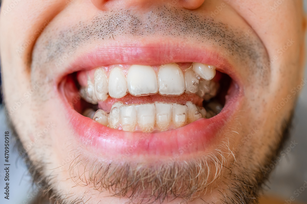 mouth of a young man. See teeth that are not aligned.teeth with ...
