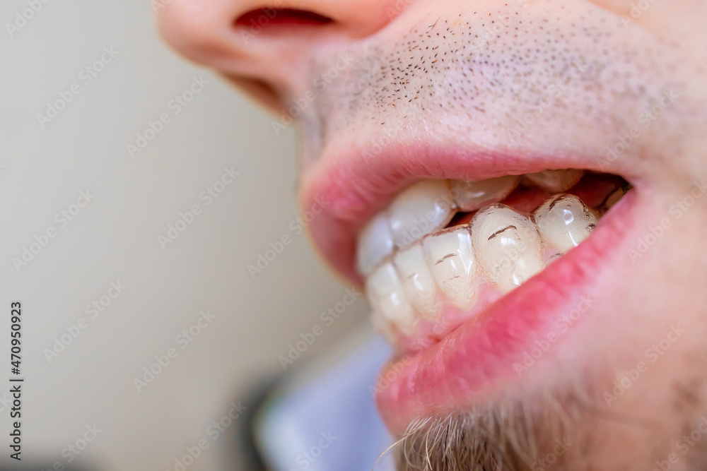 crooked teeth and malocclusion in a young man, close-up mouth using ...