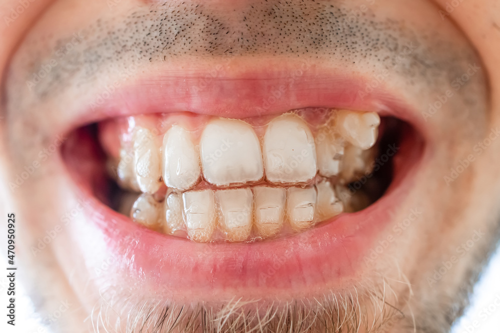 Foto de orthodontic invisible braces on crooked ugly teeth close-up ...