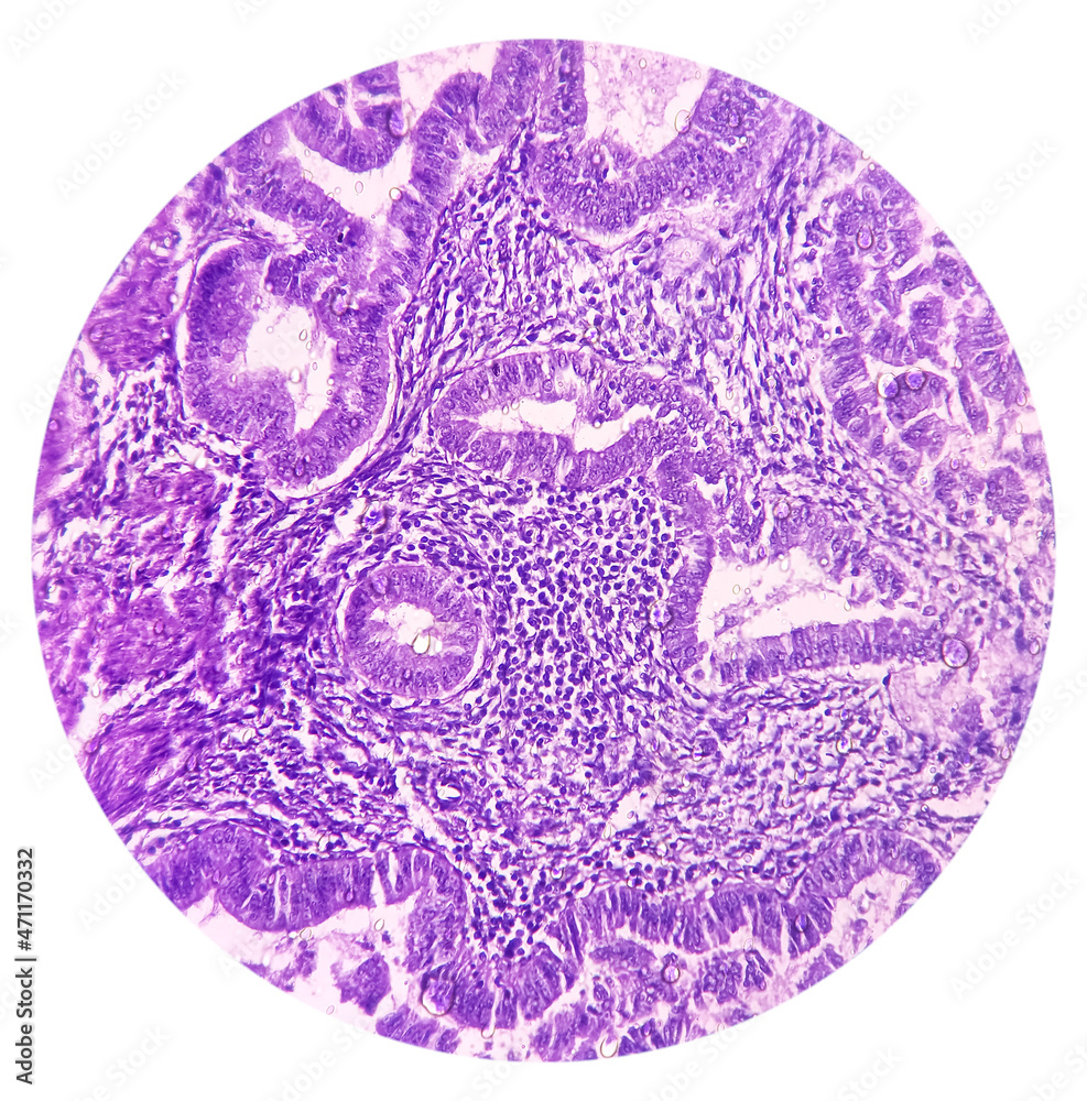 Uterus: Chronic cervicitis with CIN-1, under light microscope show ...