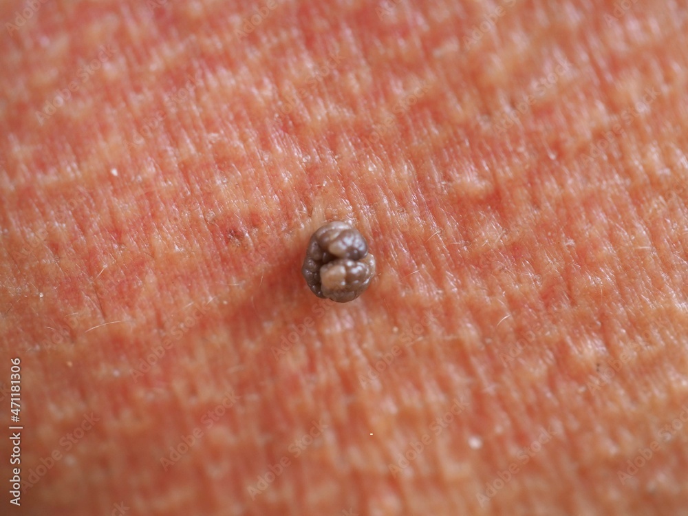 Black mole on neck asian woman of skin lesion case of proliferation of ...