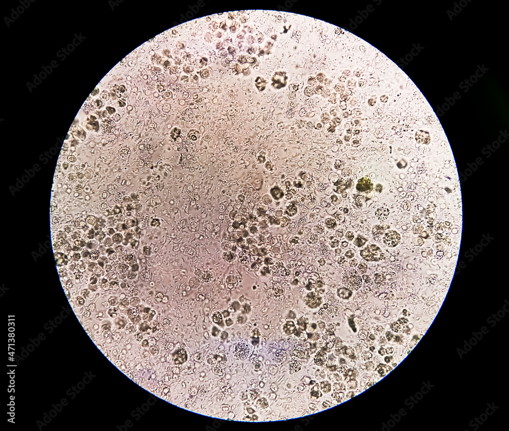 Pyuria (leukocyturia) is the condition of urine containing white blood ...