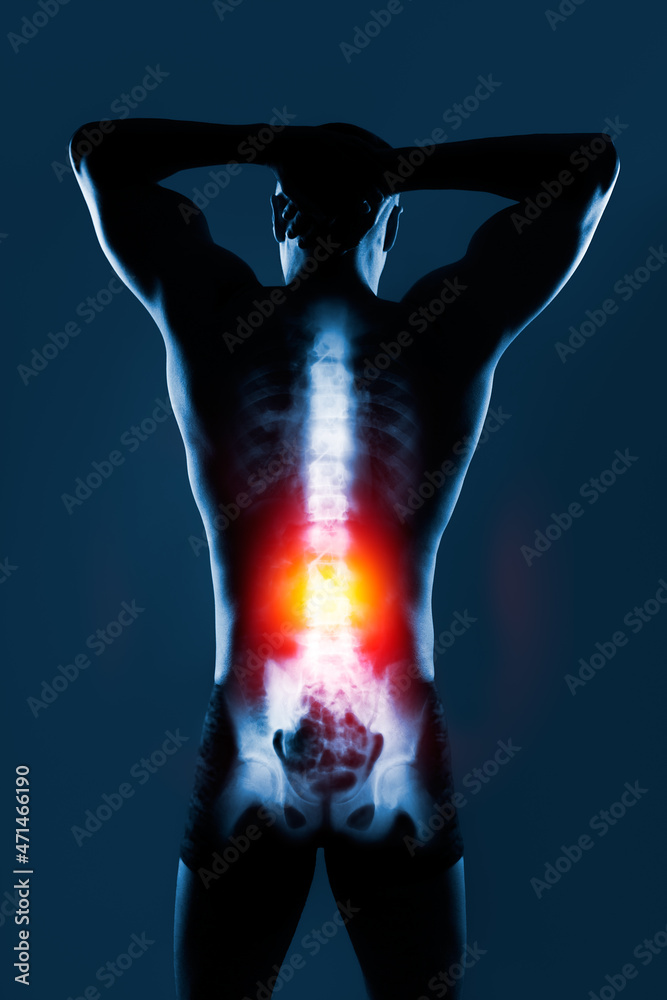 Human spine in x-ray on blue background. The lumbar spine is ...