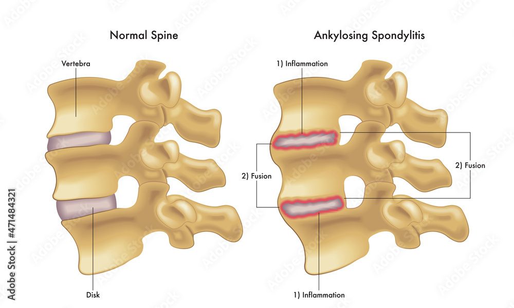 Medical illustration compares a normal spine with one showing the steps ...
