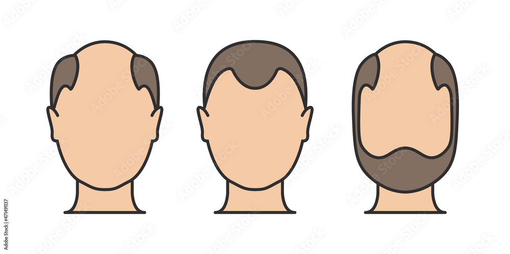 Hair loss man icon cartoon vector logo. Hair loss male scalp bald ...