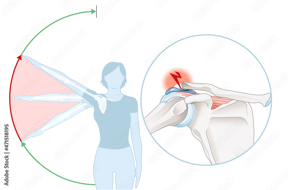 Plakat Shoulder impingement. Painful arc. Labeled illustration ...