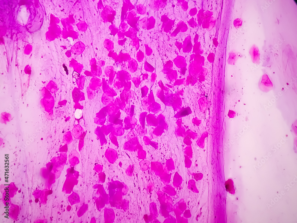 Gram Stain Gram Positive Cocci Gram Positive Diplococci Bacteria Candida Present Squamous